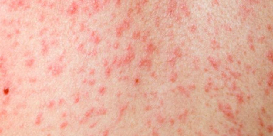 Mazelen – LUSOLOBO